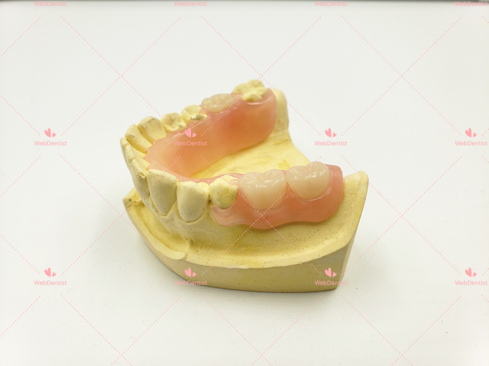 Permanently Flexible/TCS partial denture *Impression kit not included ...